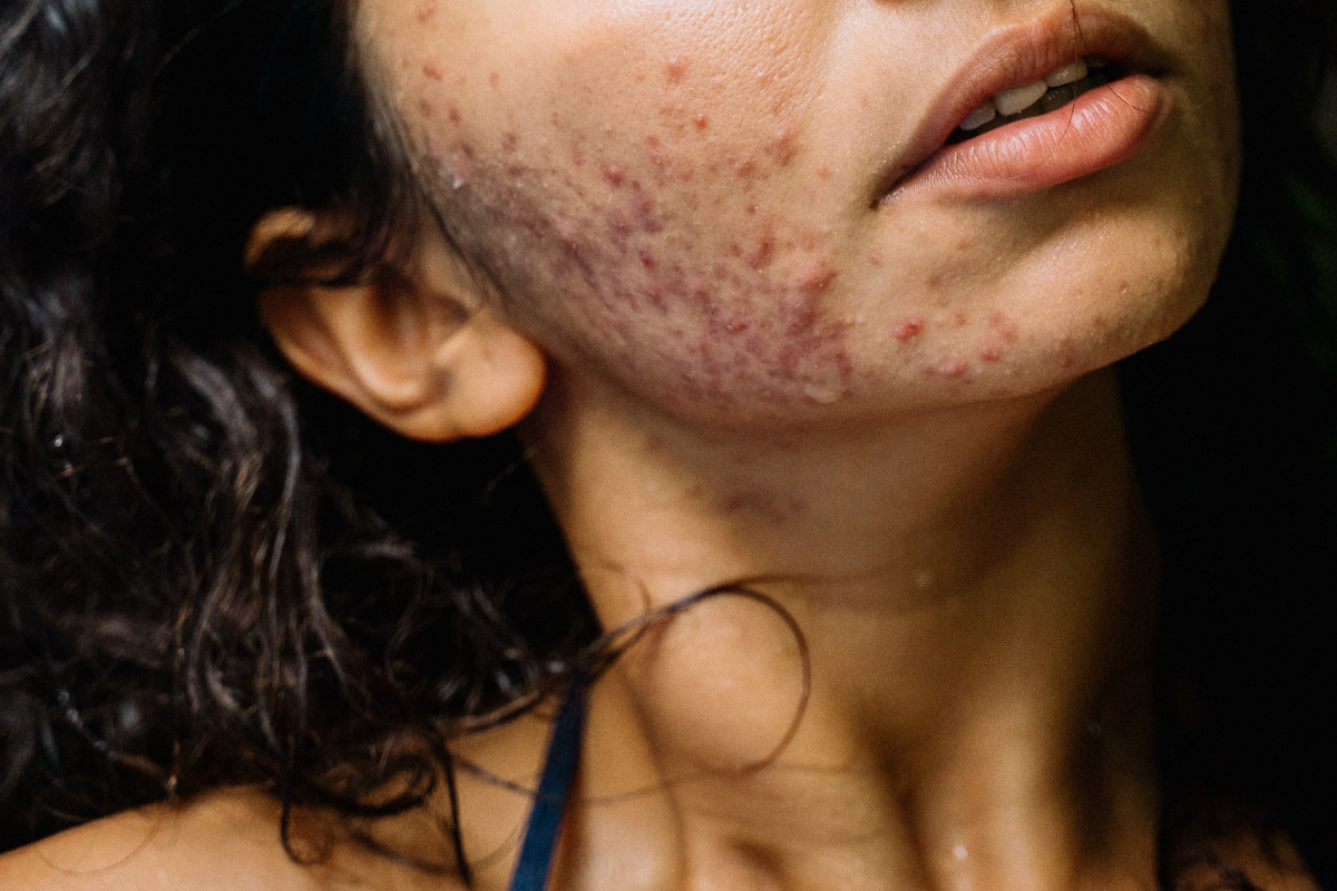 Keloids Acne